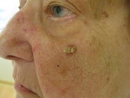 Squamous Cell Carcinoma Of The Skin Squamous Cell Carcinoma Of The Skin