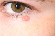 Basal Cell Carcinoma